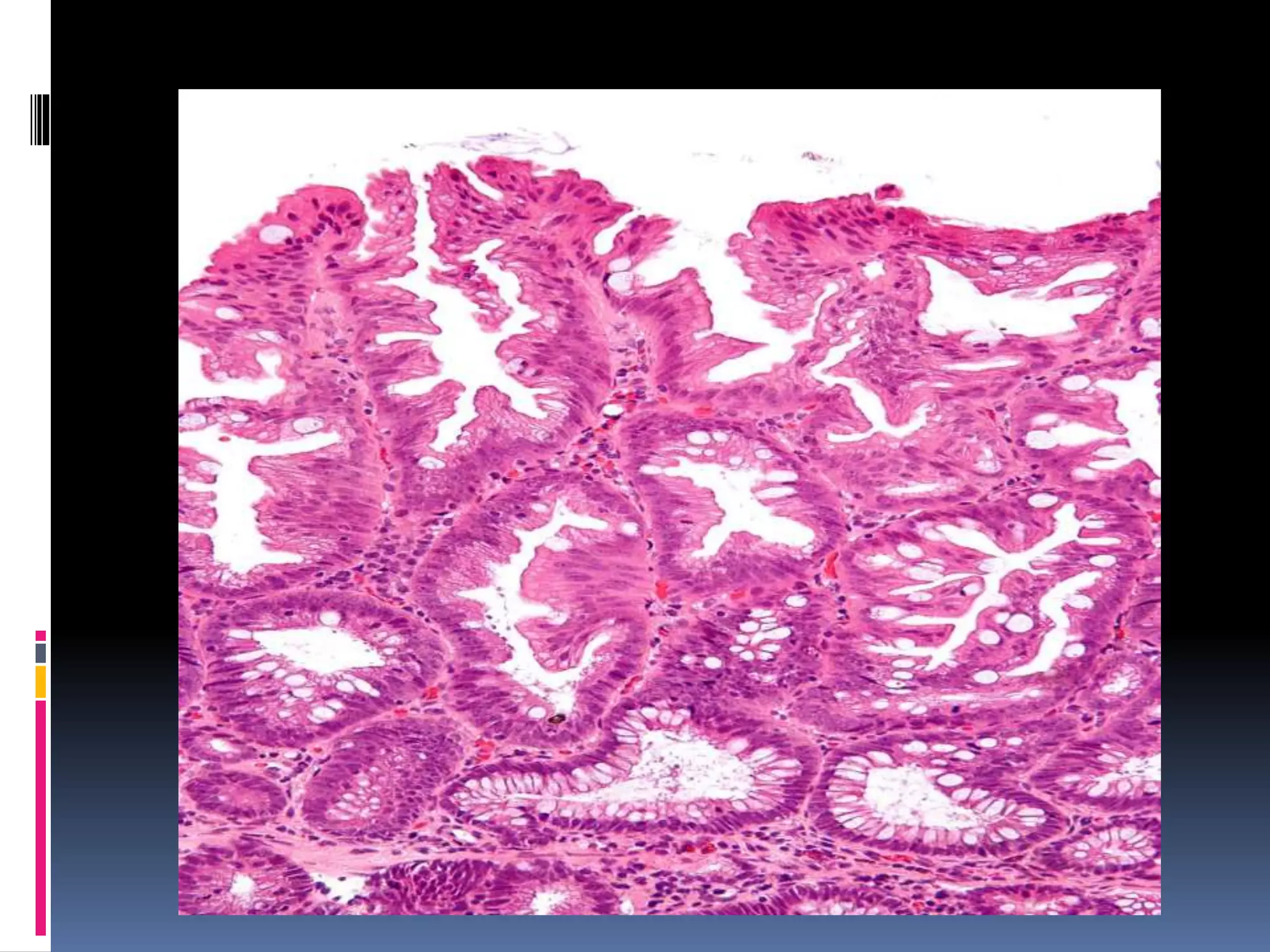Large intestinal tumors | PPTX