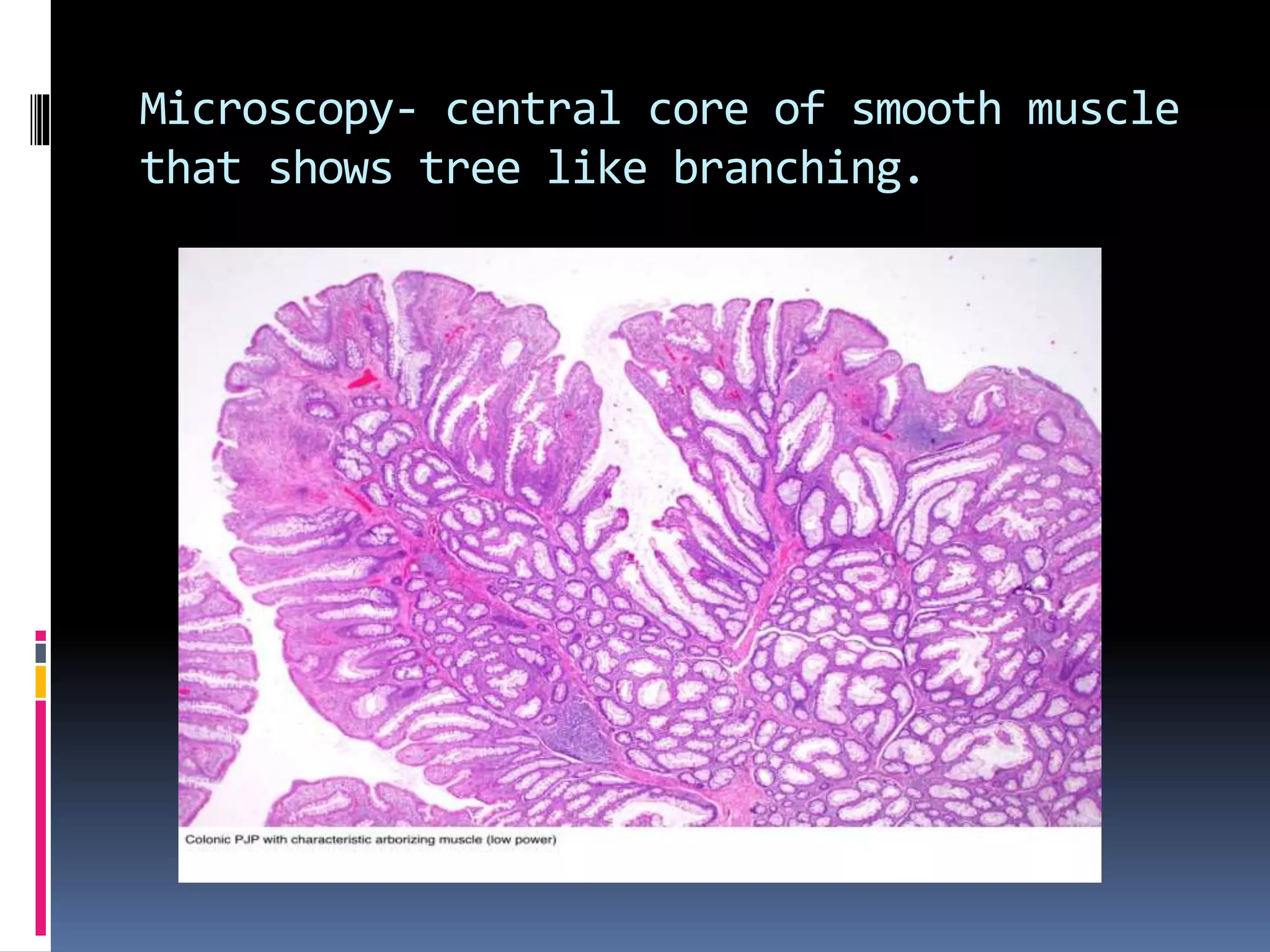 Large intestinal tumors | PPTX