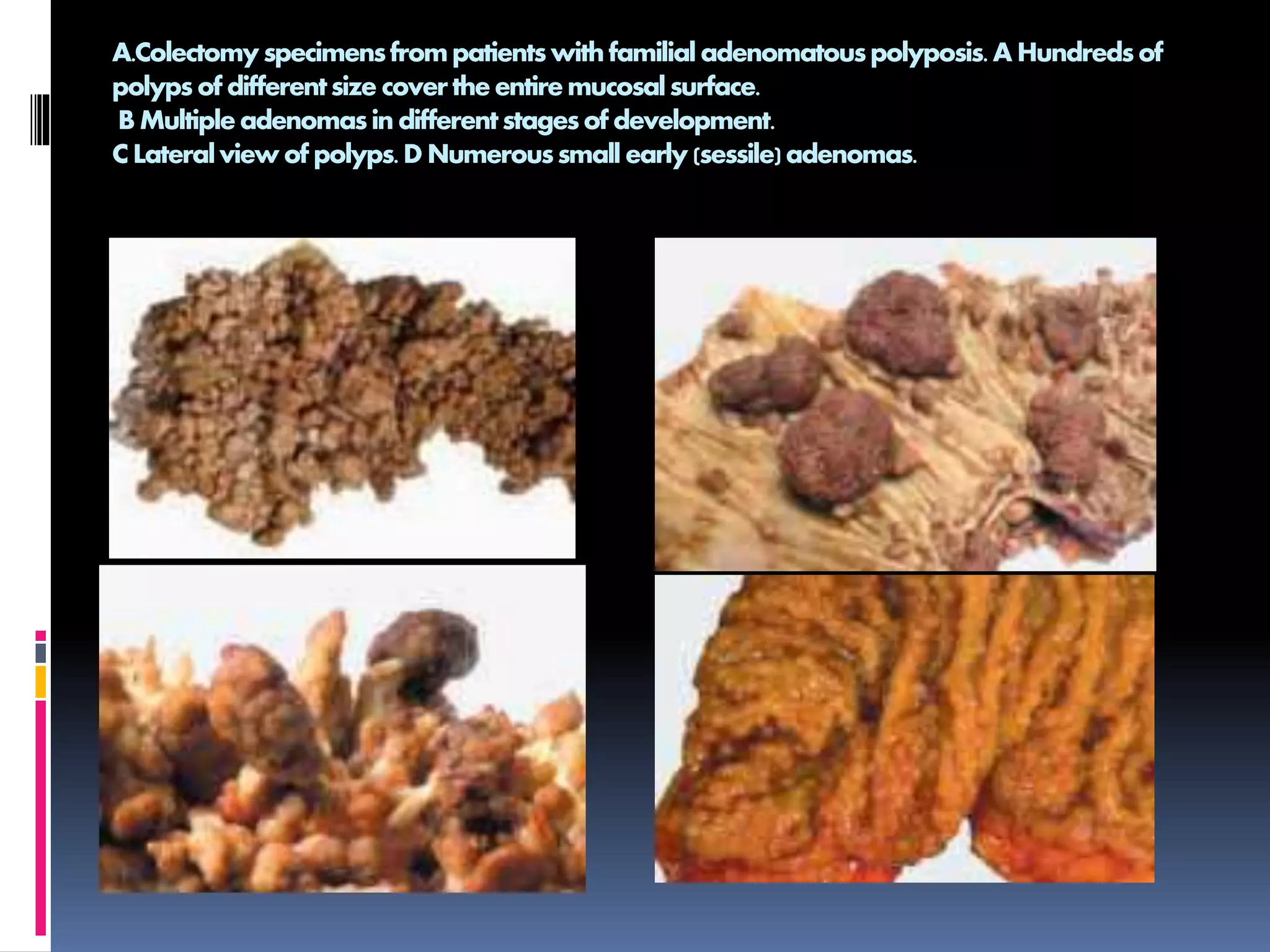 Large intestinal tumors | PPTX