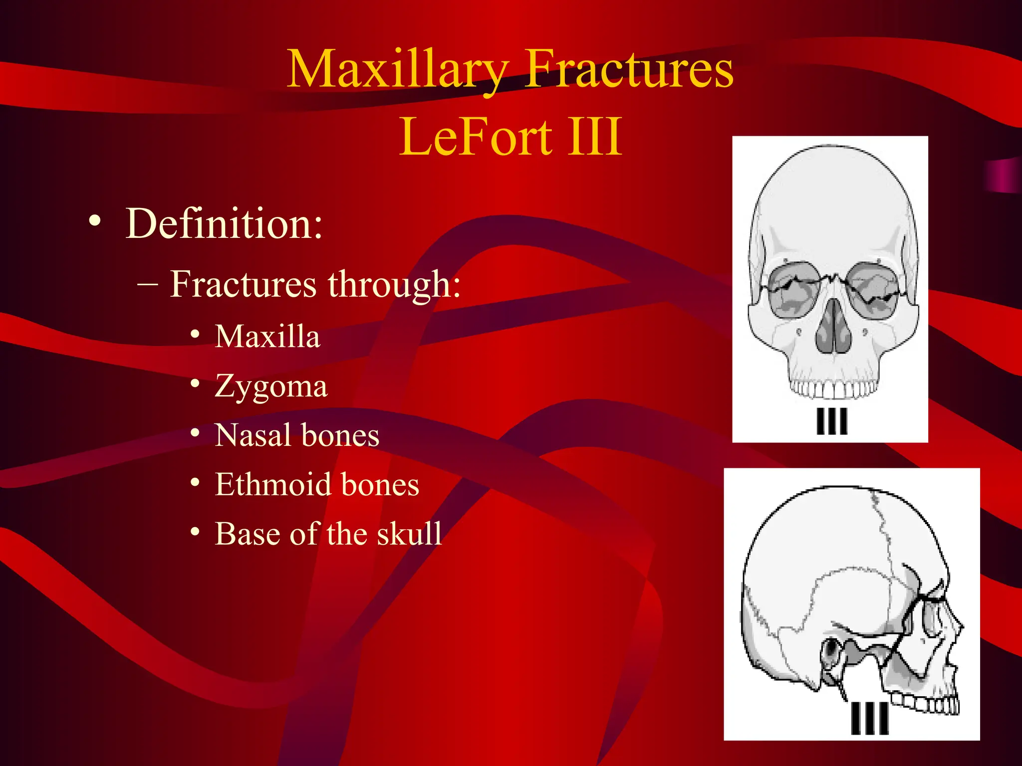 Copy of maxillary fracture and mid face.ppt