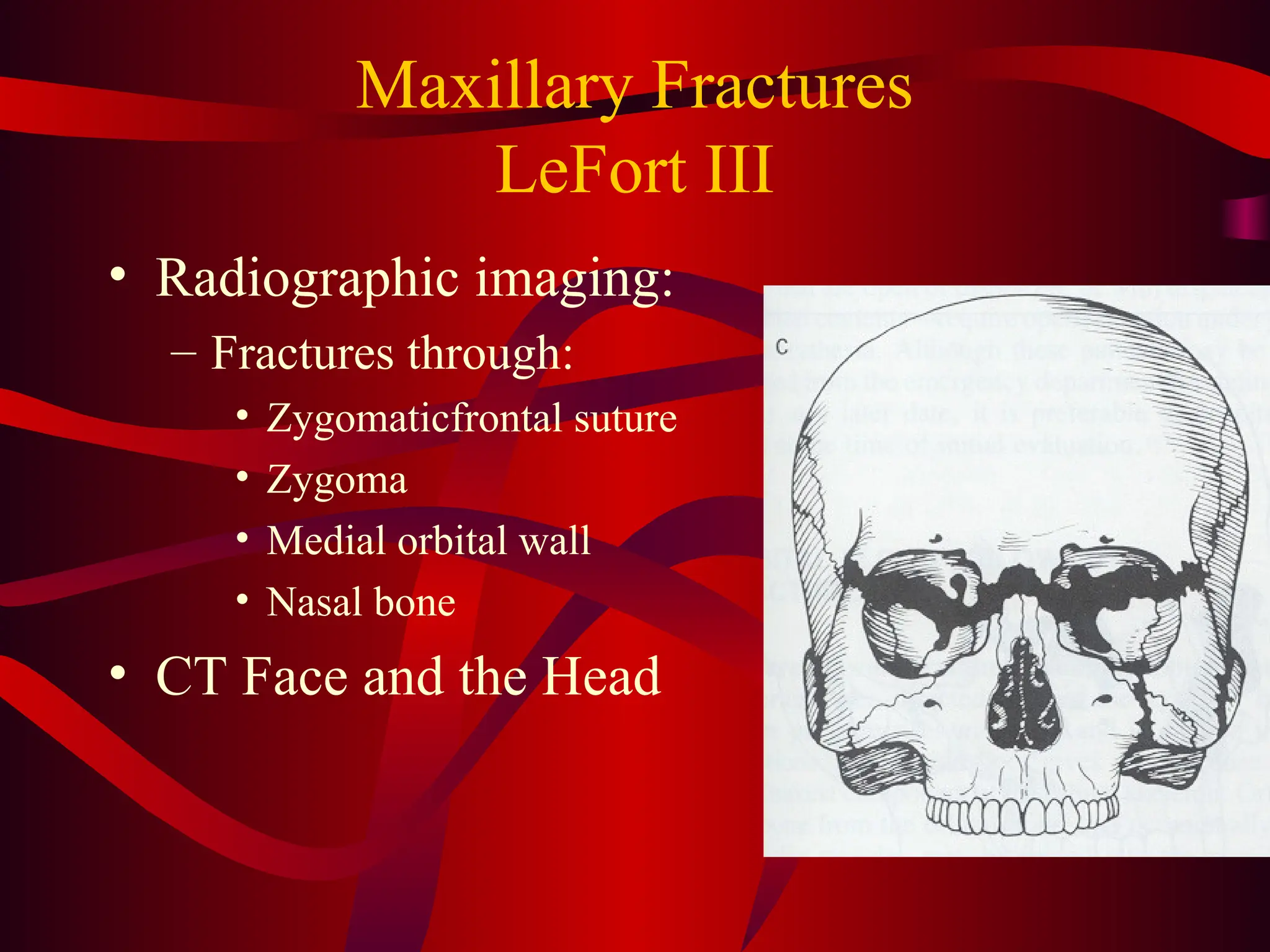 Copy of maxillary fracture and mid face.ppt