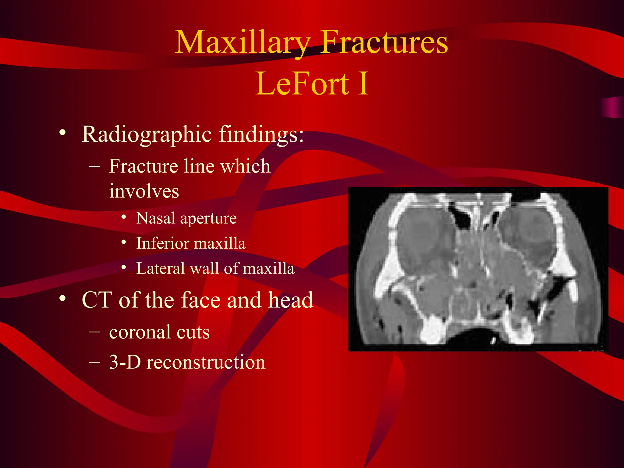Copy of maxillary fracture and mid face.ppt