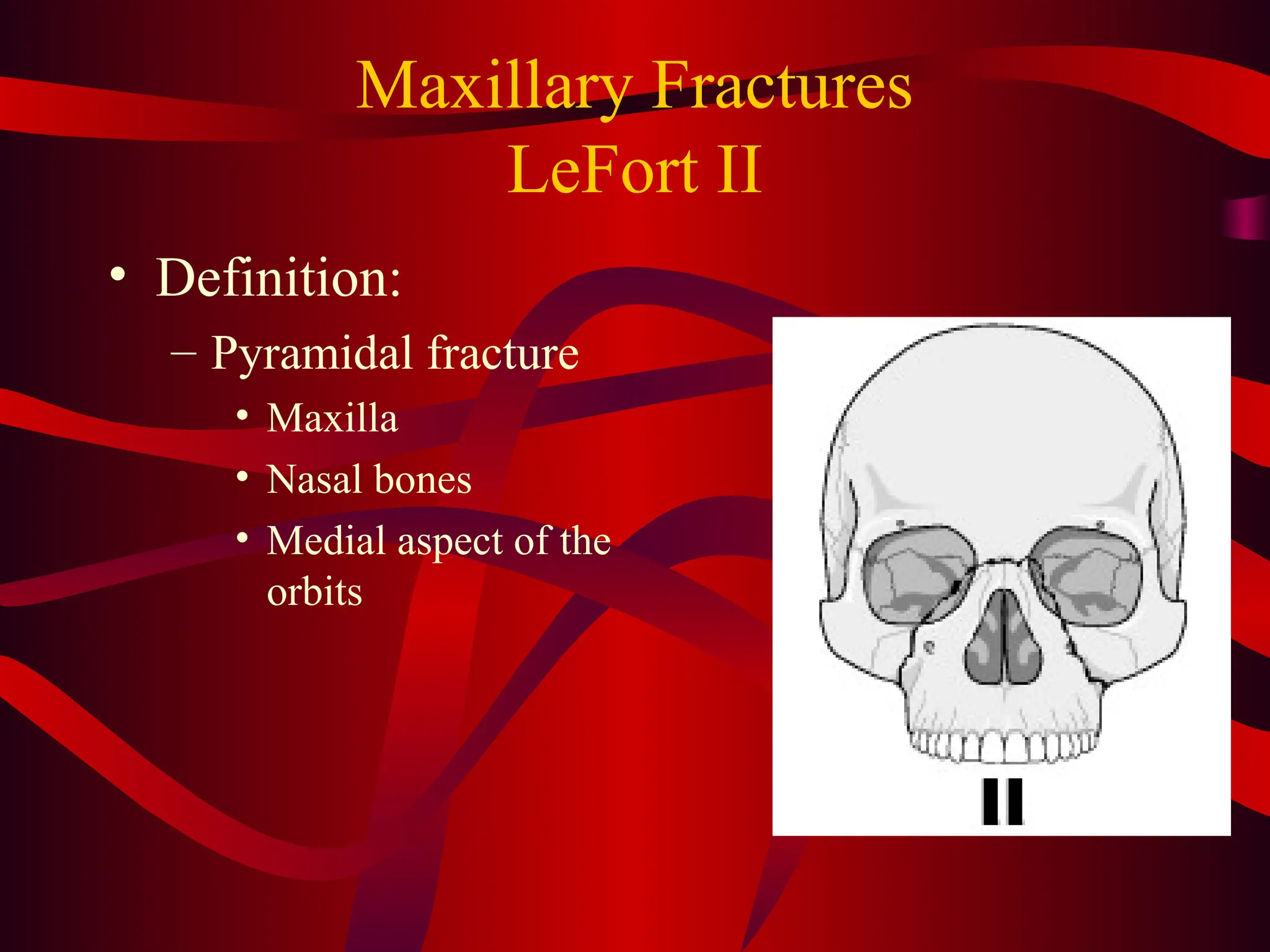 Copy of maxillary fracture and mid face.ppt