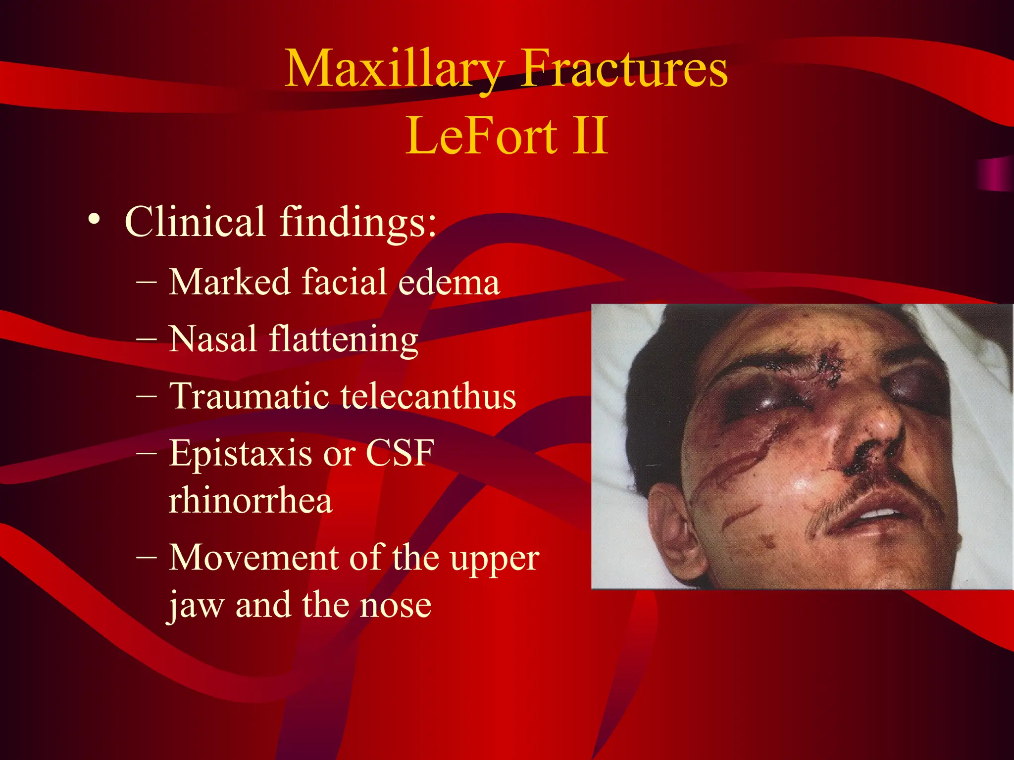 Copy of maxillary fracture and mid face.ppt