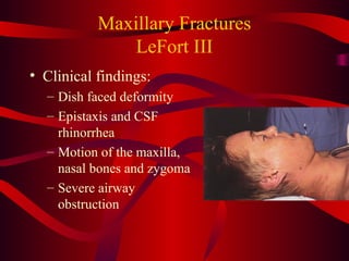 Copy of maxillary fracture and mid face.ppt