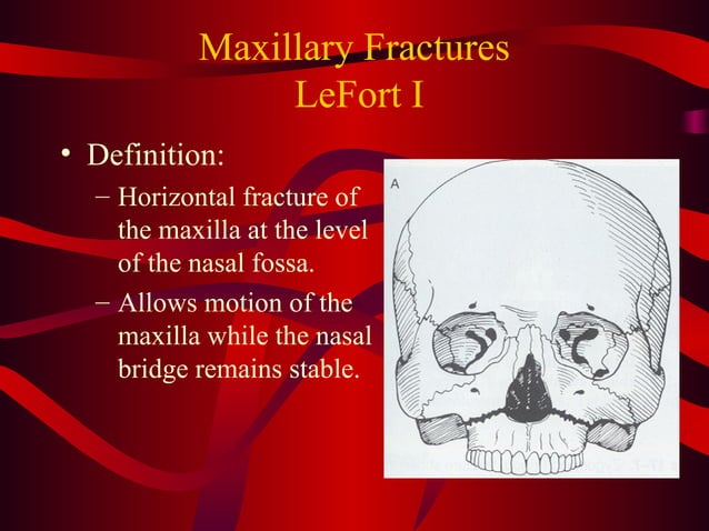 Copy of maxillary fracture and mid face.ppt