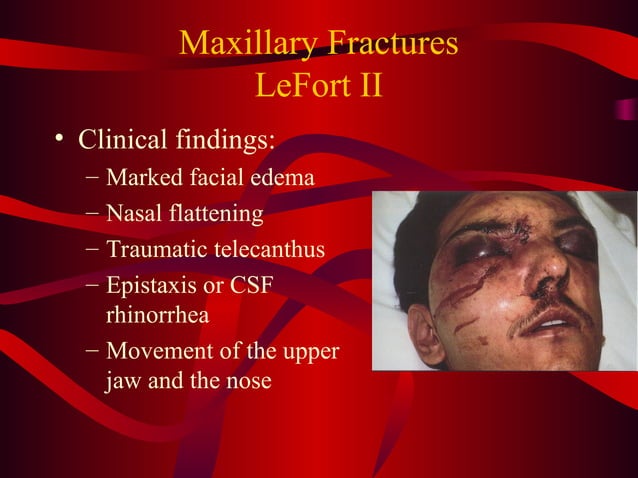 Copy of maxillary fracture and mid face.ppt