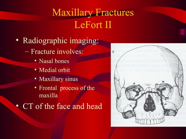 Copy of maxillary fracture and mid face.ppt