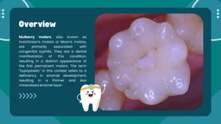 Mulberry Molars A Developmental Anomaly of Permanent Molars.pdf