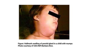 Mumps.ppt Community Medicine | PPT