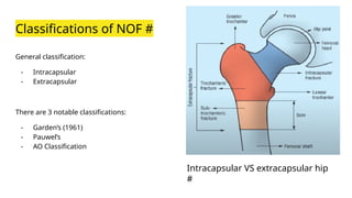 Neck of Femur Fractures in malaysia.pptx | Bone and Joint Conditions ...