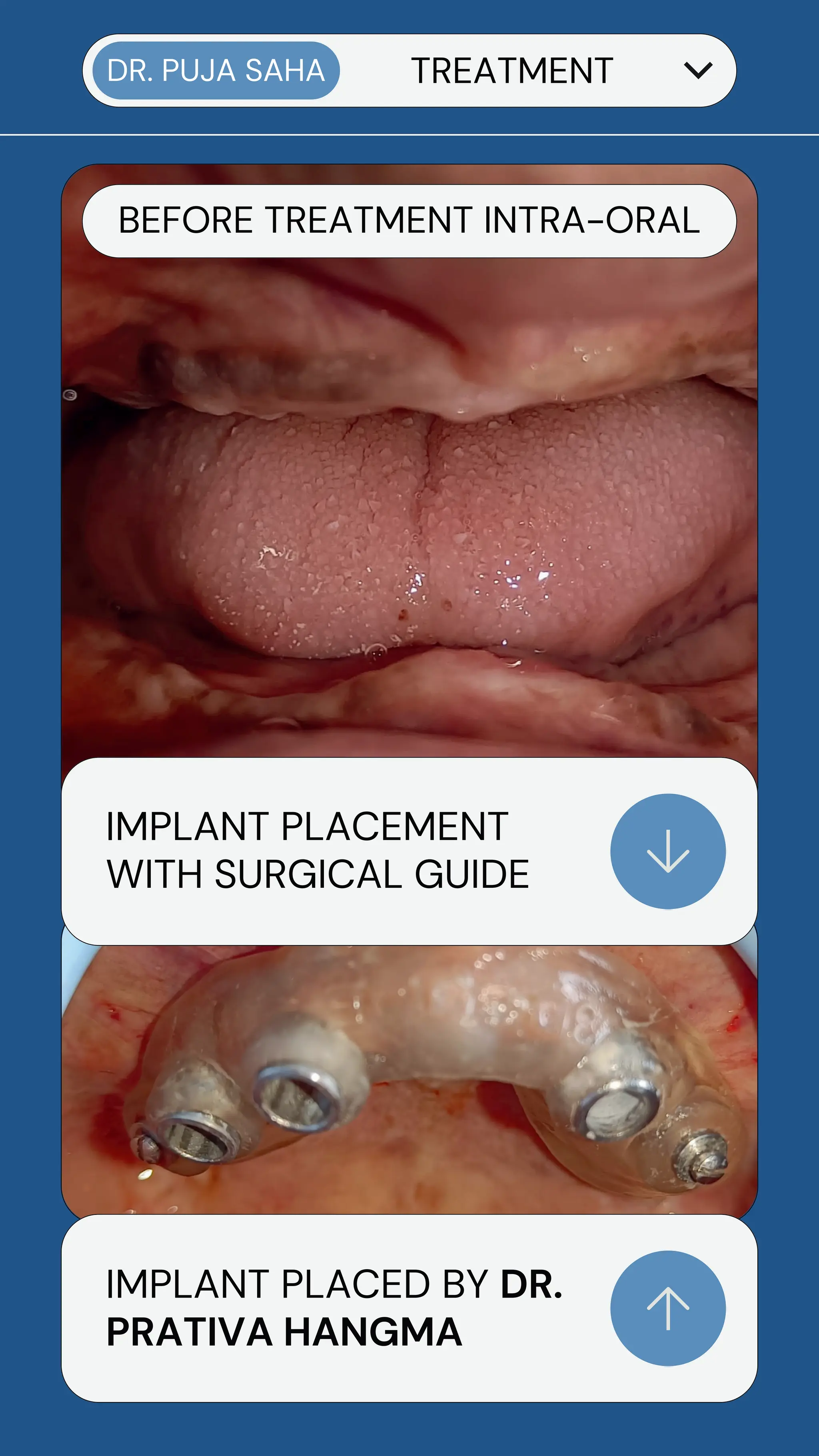 Complete smile makeover with Implant retained complete denture with ...