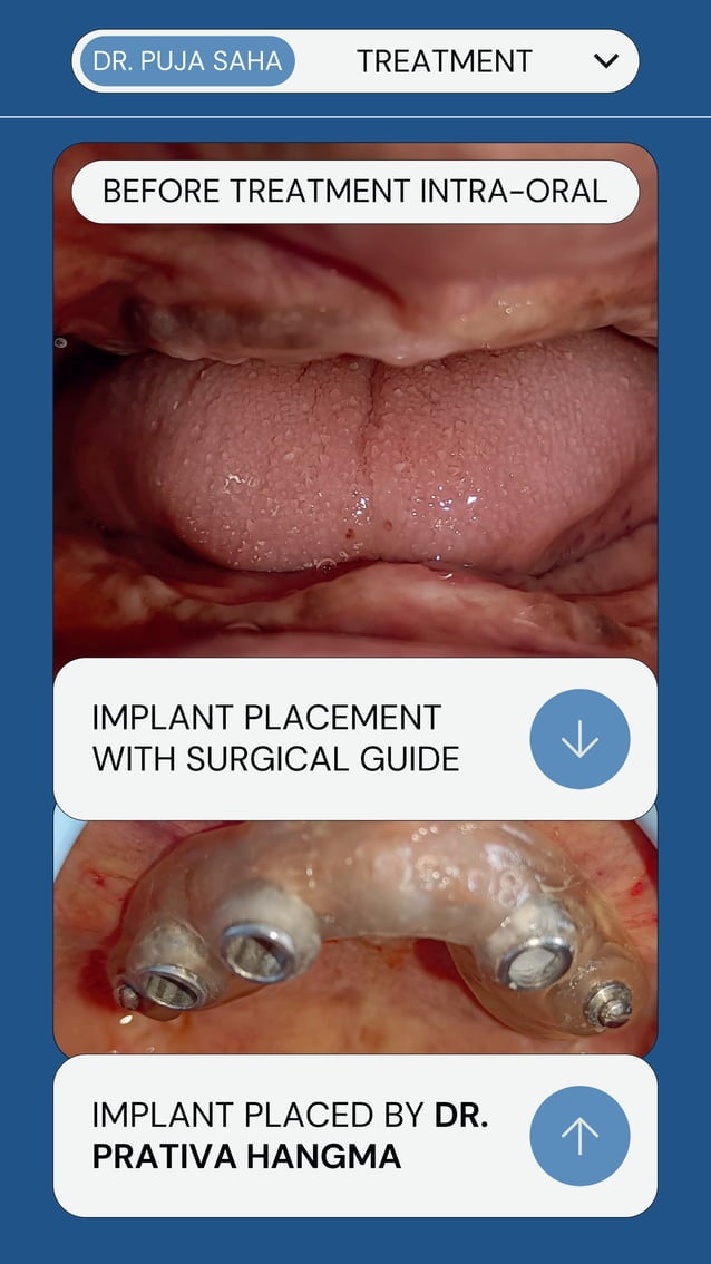 Complete smile makeover with Implant retained complete denture with ...