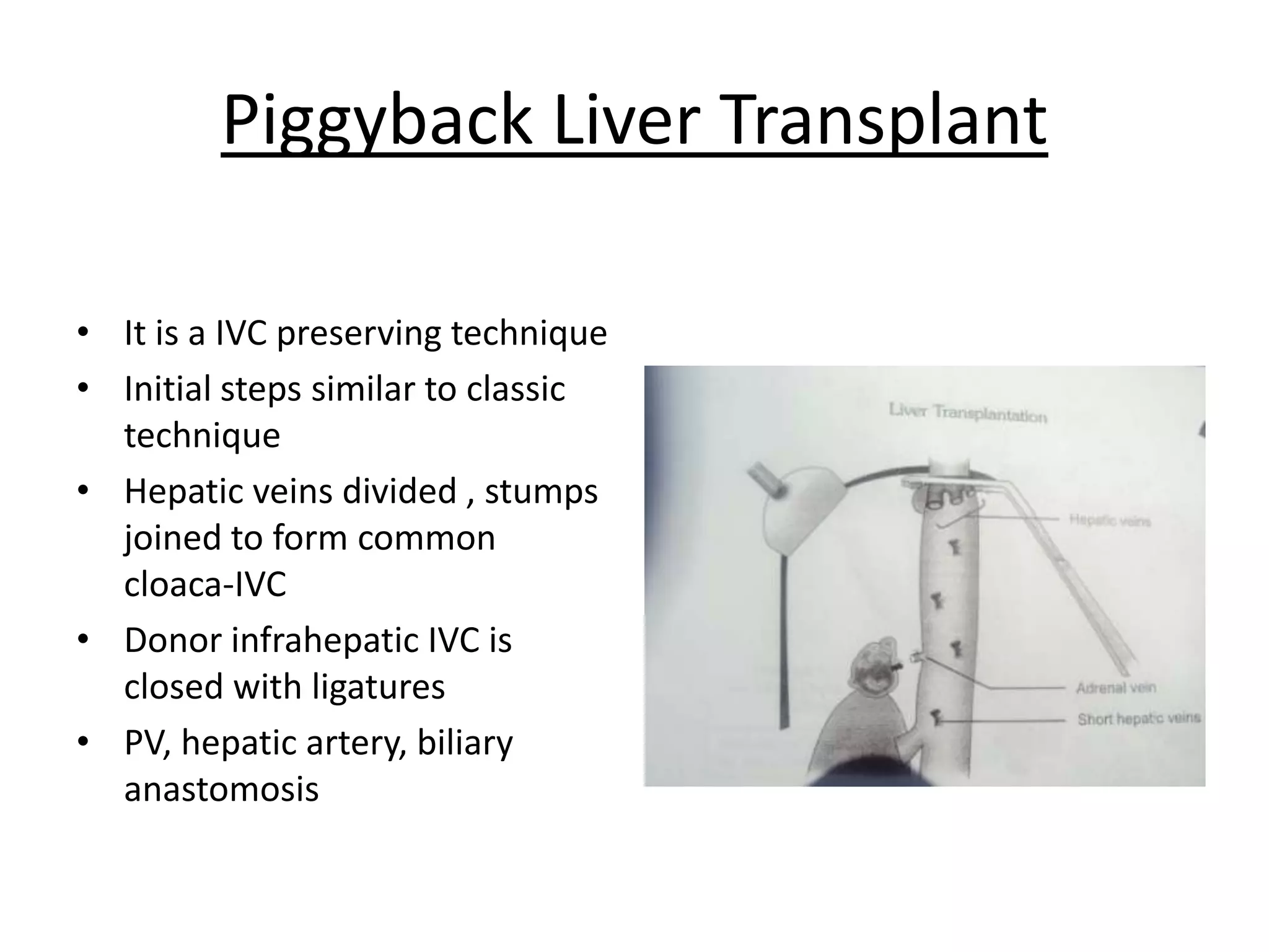 Copy of organ transplant 123 | PPTX