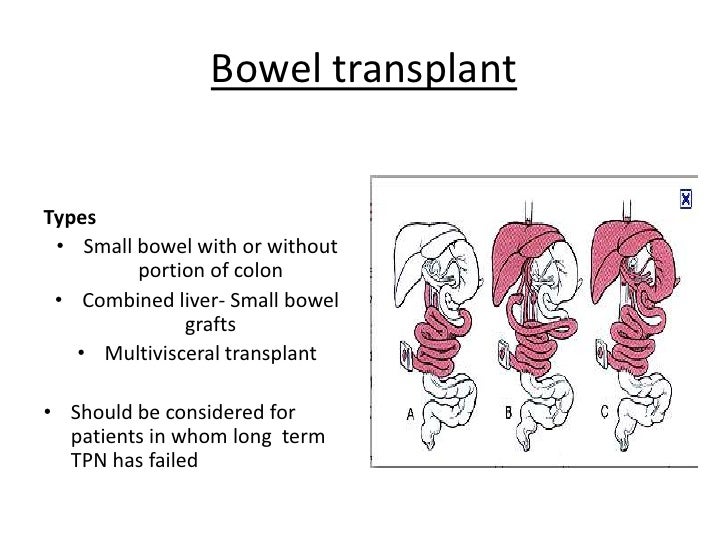 Copy of organ transplant 123