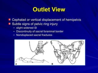 Copy of pelvic_fractures_o6th_u_presentation by dr. mahmoud Abdel ...