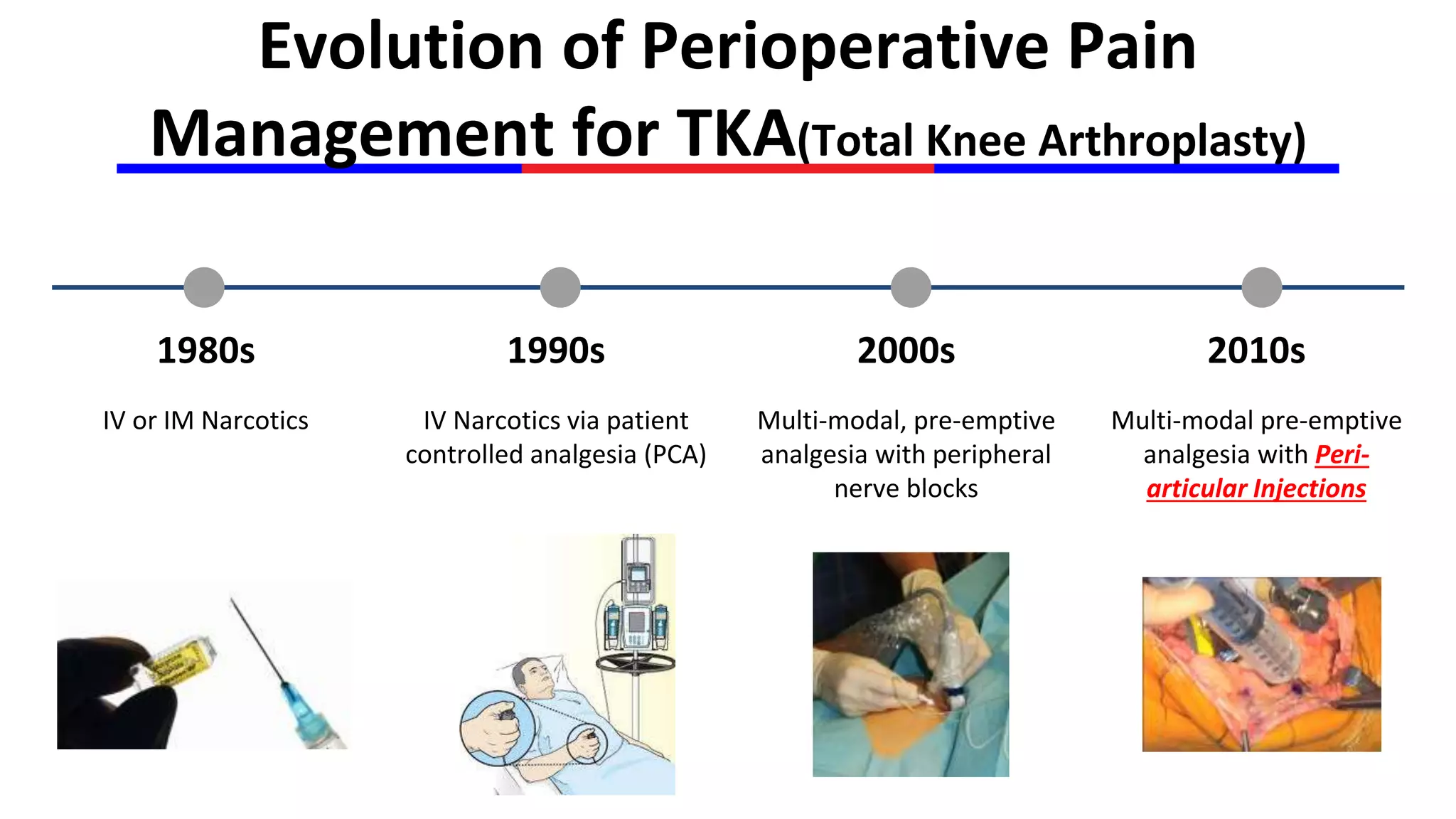 Knee Arthroplasty Intra-Articular Injection cocktail | PPTX