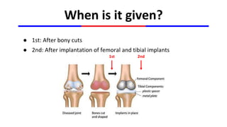 Knee Arthroplasty Intra-Articular Injection cocktail | PPTX