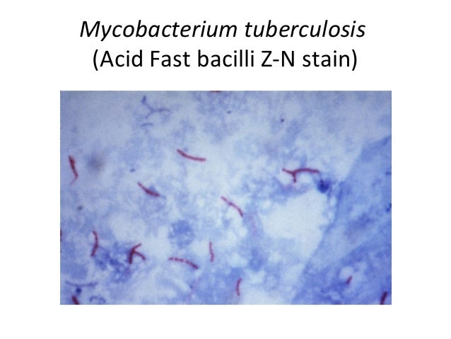 Mycobacterium Tuberculosis Acid Fast Acid Fast Bacterium An Overview
