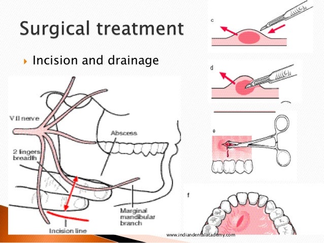 Copy of sequlae of odontogenic infections / dental implant courses