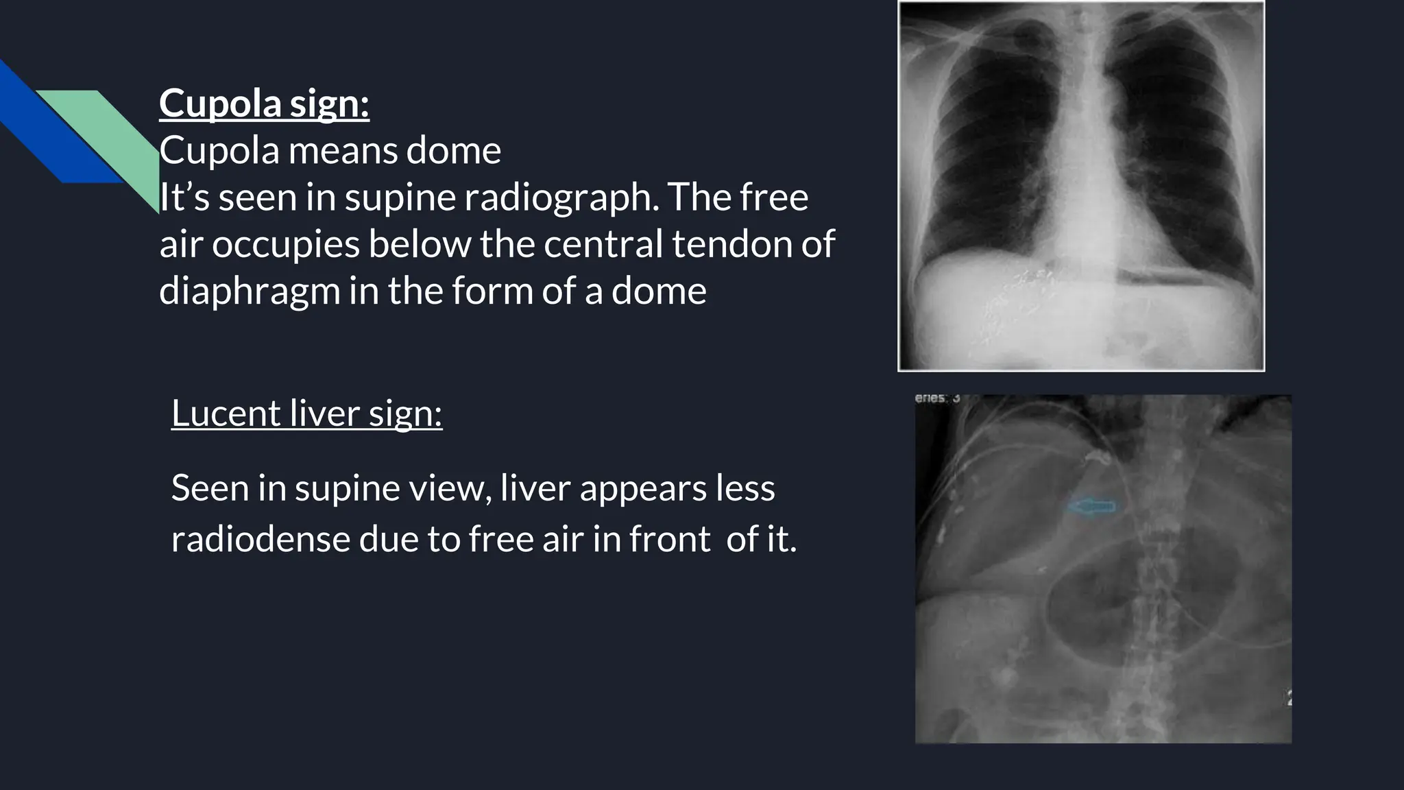 Approach to X ray Abdomen and KUB.pptx
