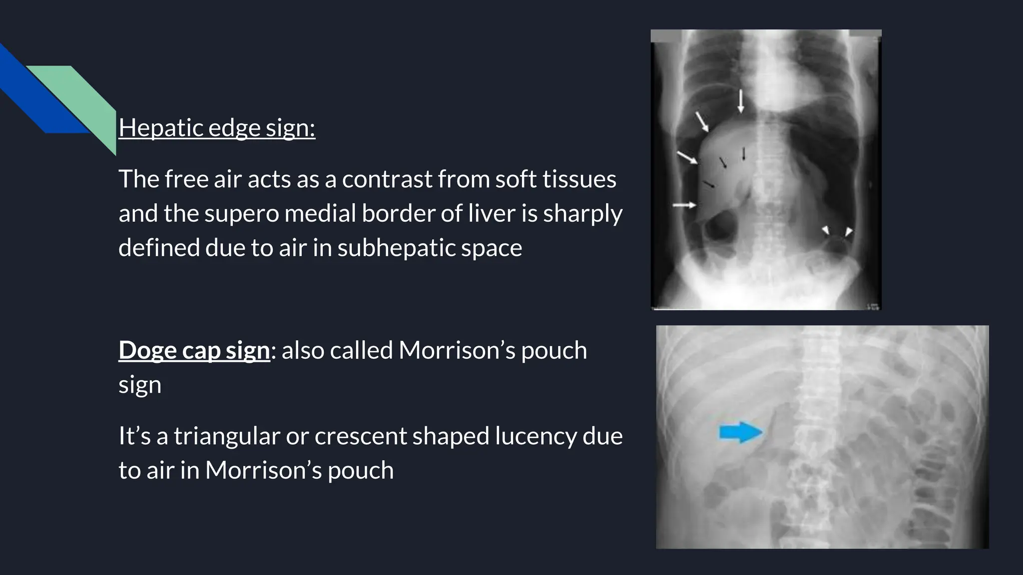 Approach to X ray Abdomen and KUB.pptx