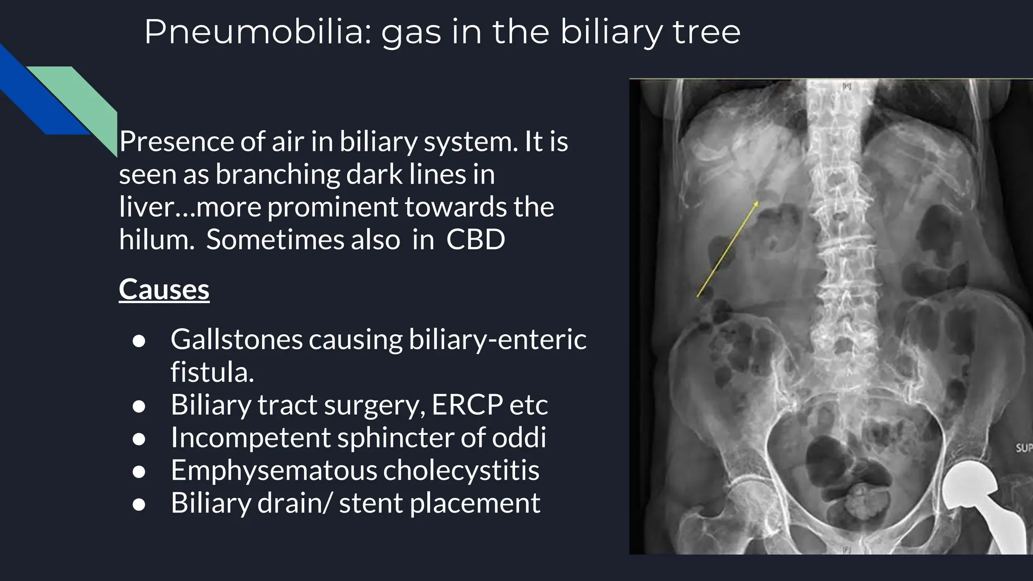 Approach to X ray Abdomen and KUB.pptx