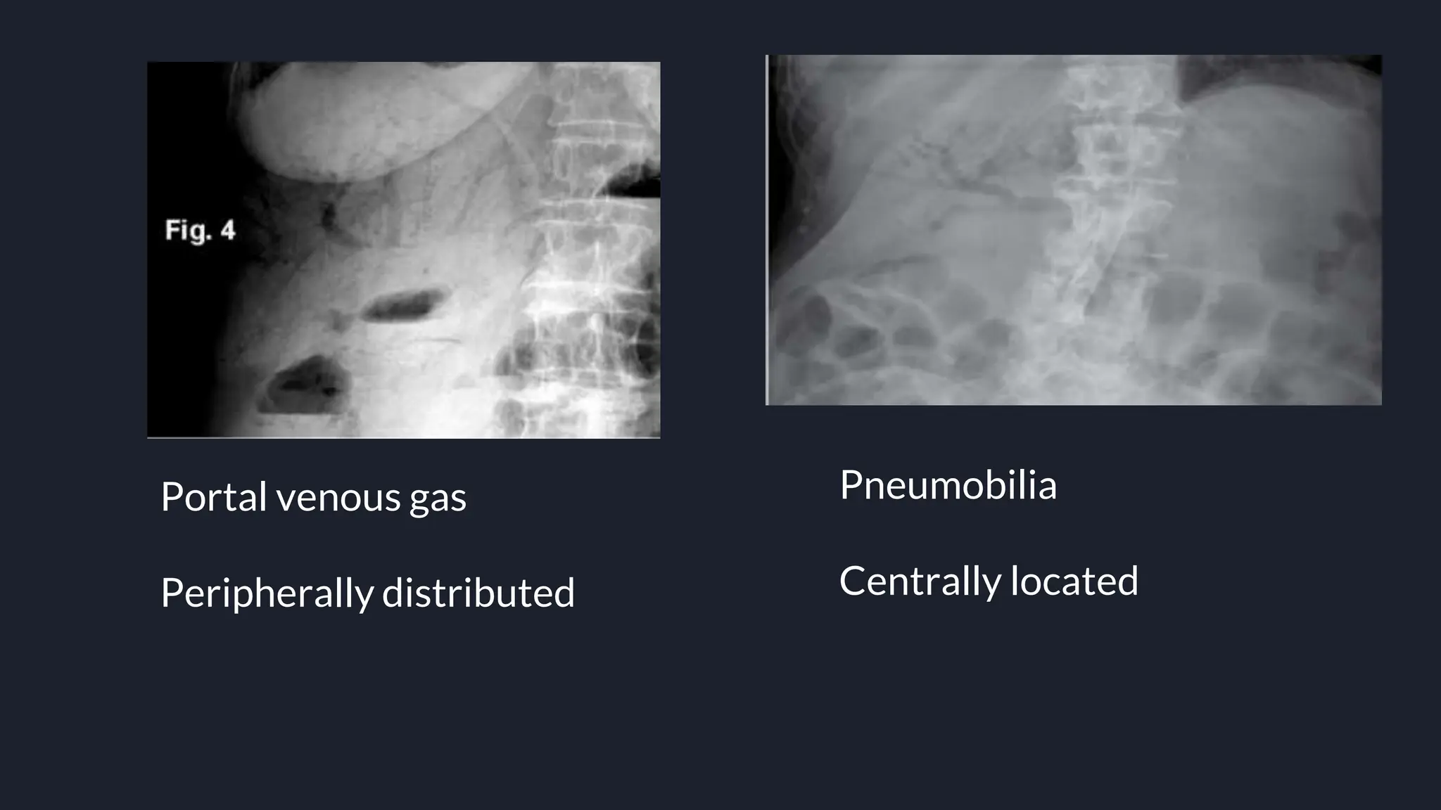 Approach to X ray Abdomen and KUB.pptx