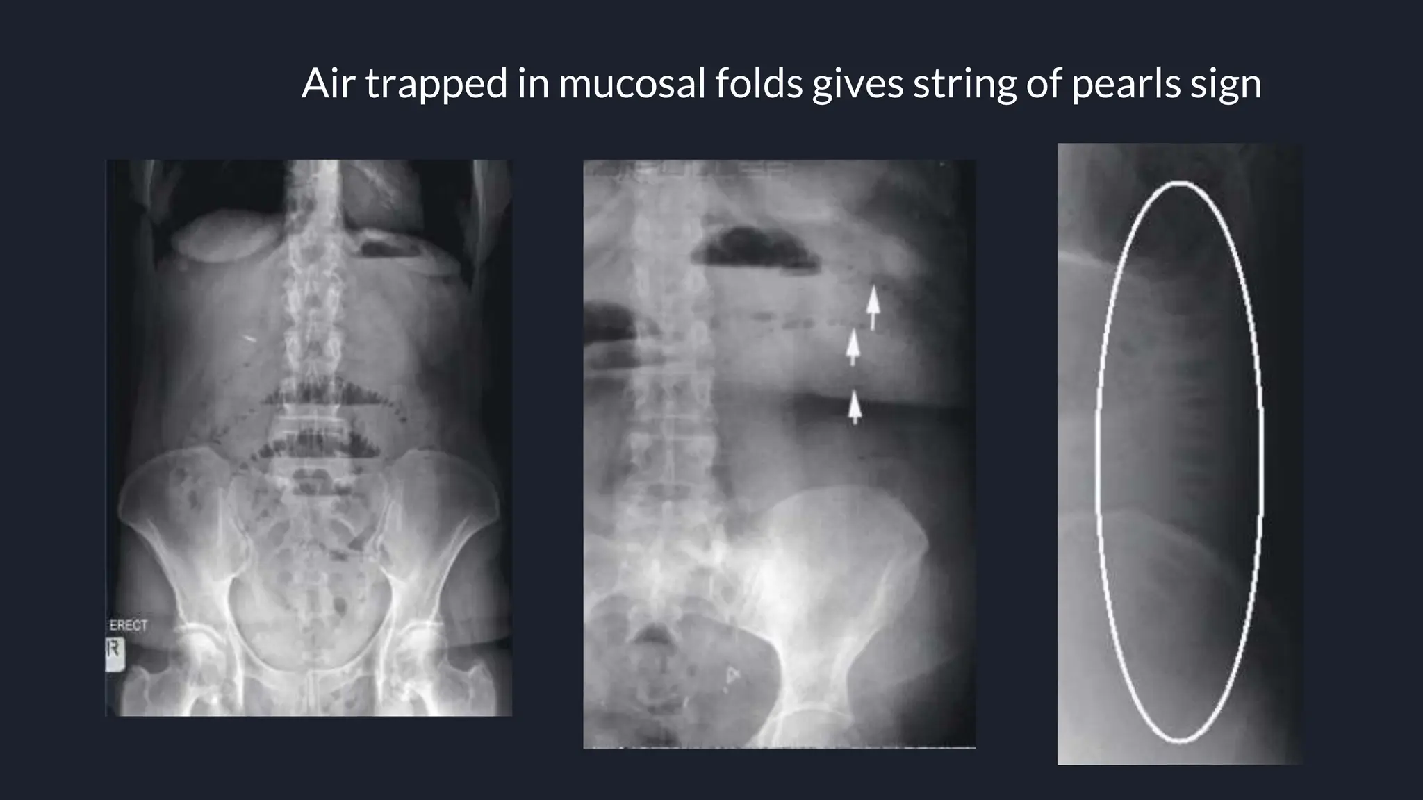 Approach to X ray Abdomen and KUB.pptx