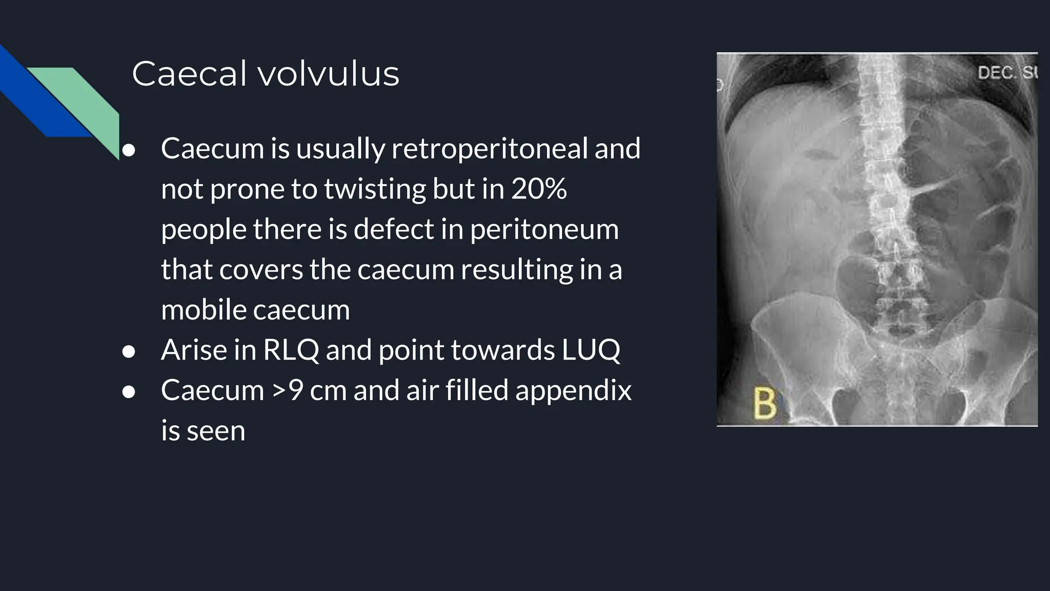 Approach to X ray Abdomen and KUB.pptx