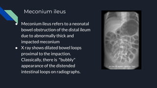 Approach to X ray Abdomen and KUB.pptx
