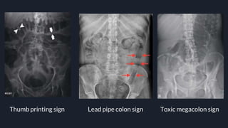 Approach to X ray Abdomen and KUB.pptx