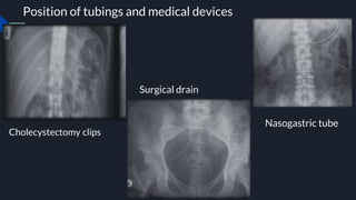 Approach to X ray Abdomen and KUB.pptx