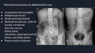 Approach to X ray Abdomen and KUB.pptx