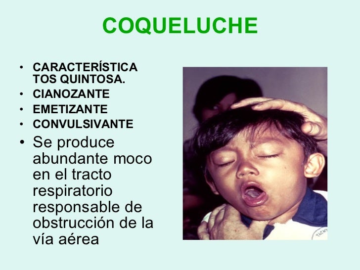 COQUELUCHE