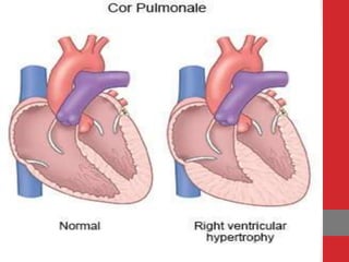 Cor - Pulmonale.pptx