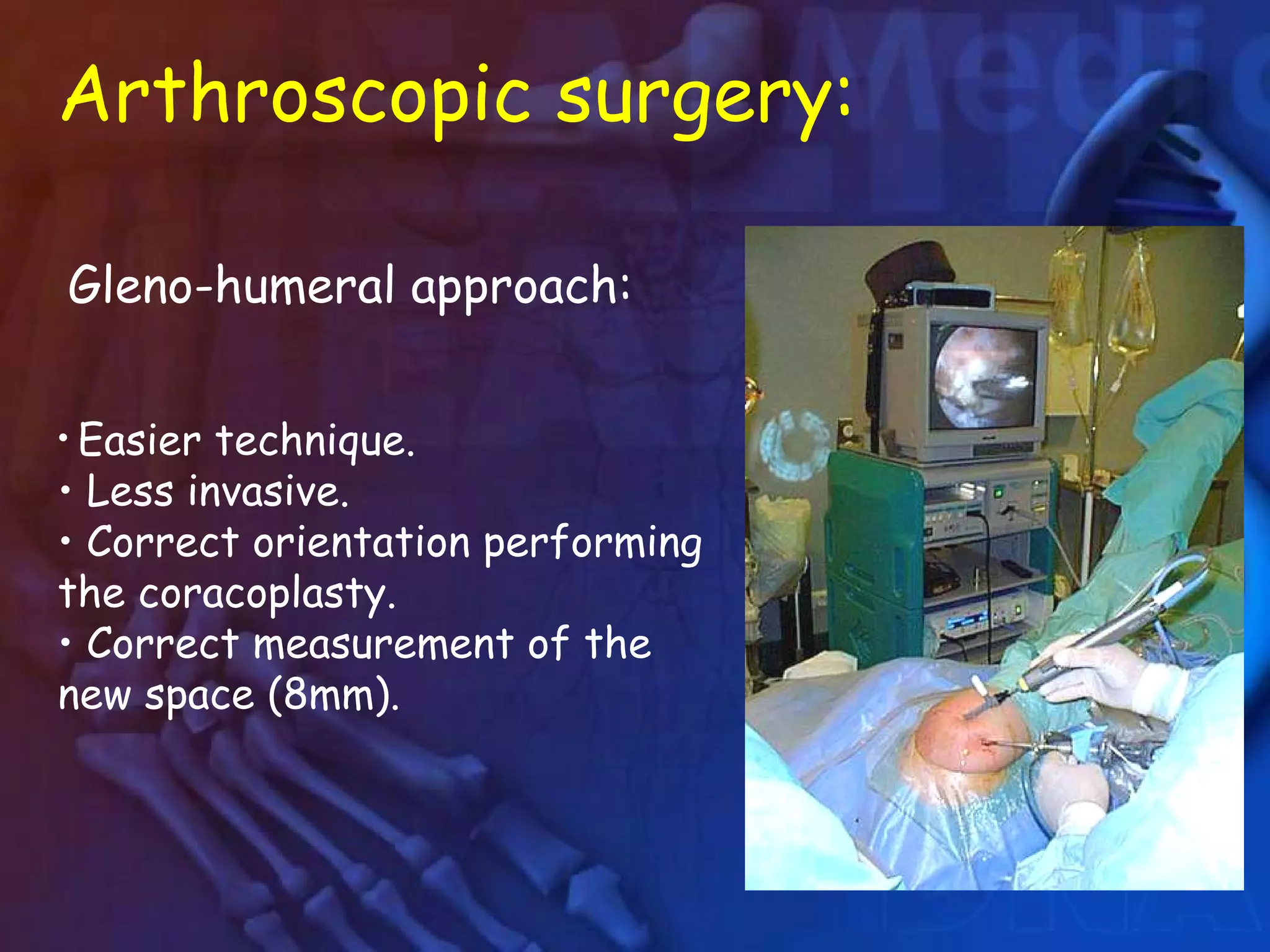 Coracoplastia, Artroscopia de hombro | PPT