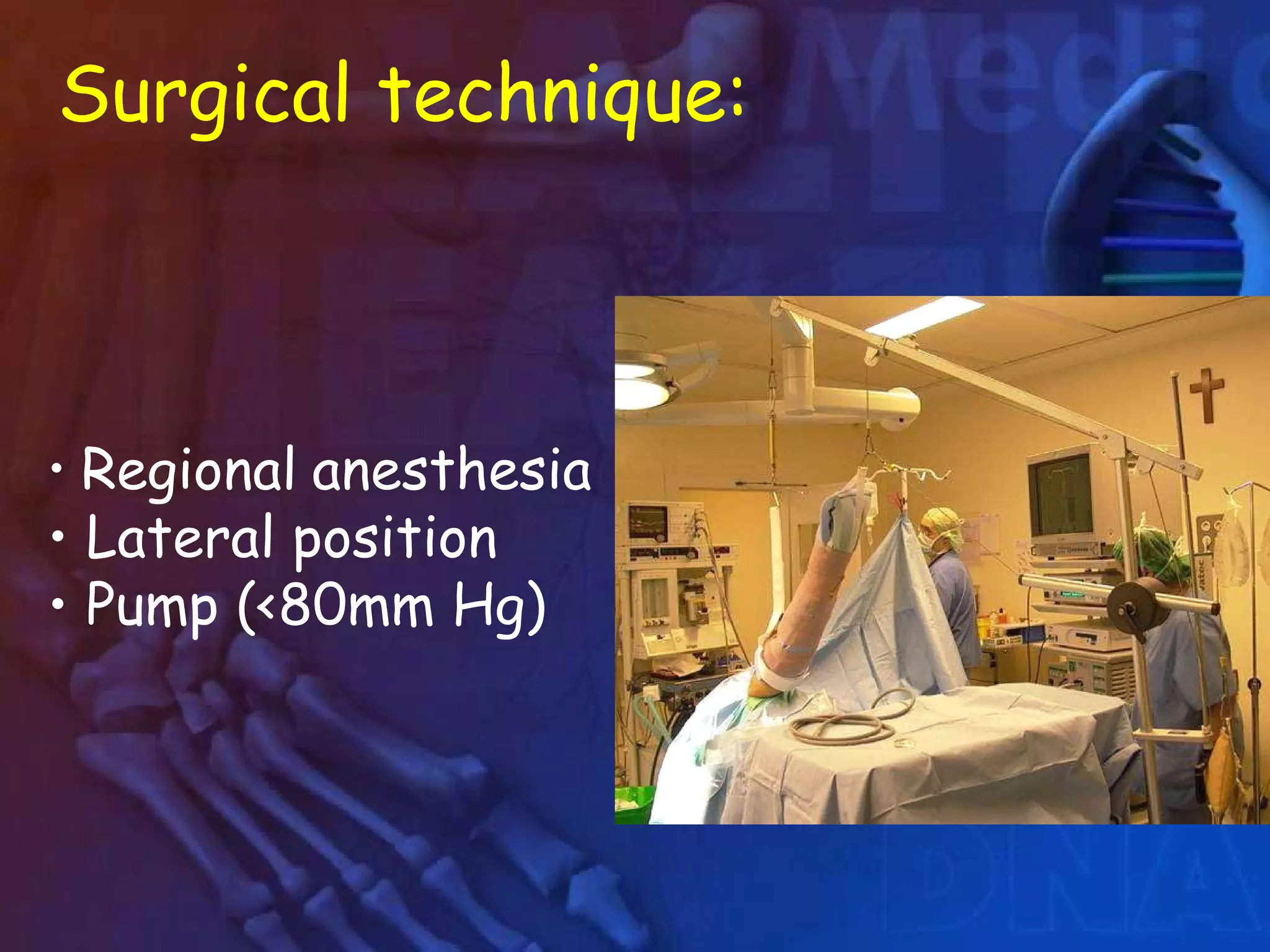 Coracoplastia, Artroscopia de hombro | PPT