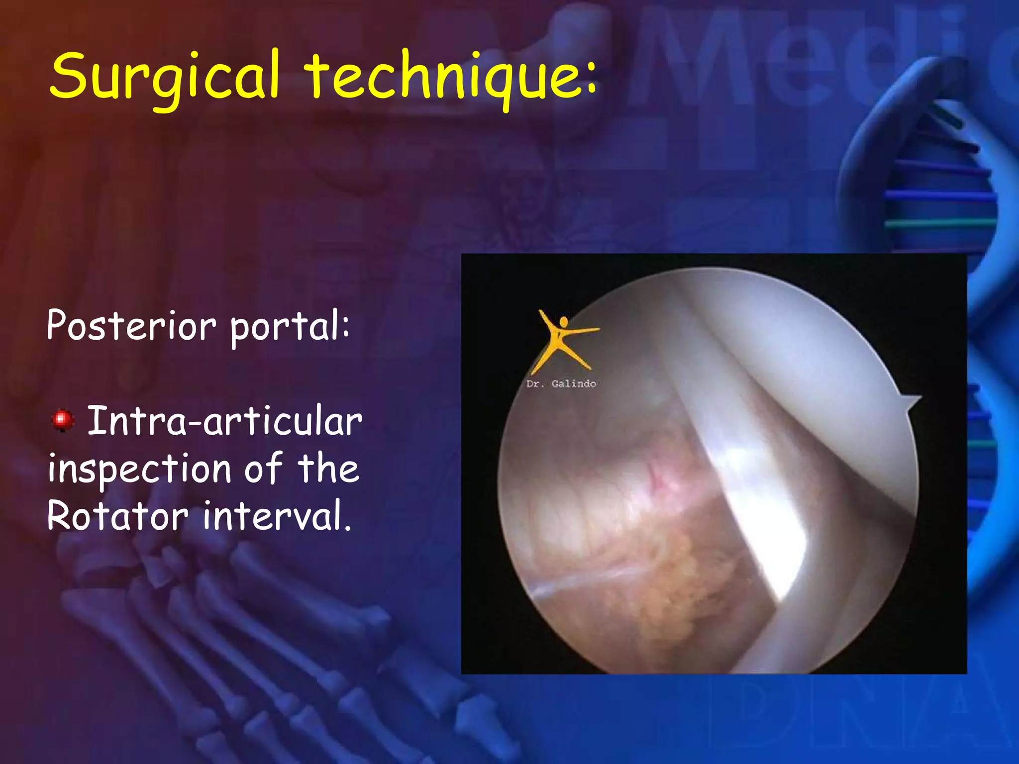 Coracoplastia, Artroscopia de hombro | PPT