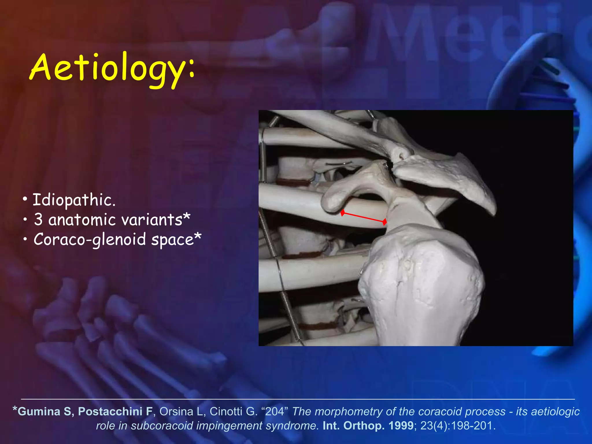 Coracoplastia, Artroscopia de hombro | PPT