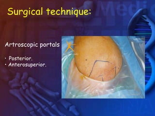 Coracoplastia, Artroscopia de hombro | PPT