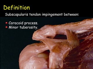 Coracoplastia, Artroscopia de hombro | PPT