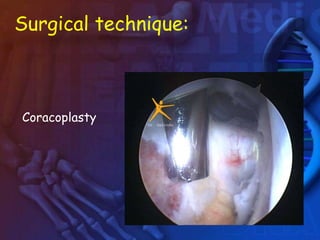 Coracoplastia, Artroscopia de hombro | PPT