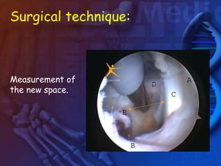 Coracoplastia, Artroscopia de hombro | PPT