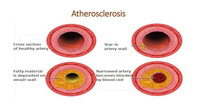 Coranary artery diseae.pptx