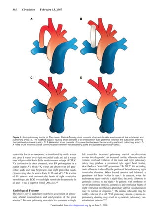 Coração univentricular | PDF
