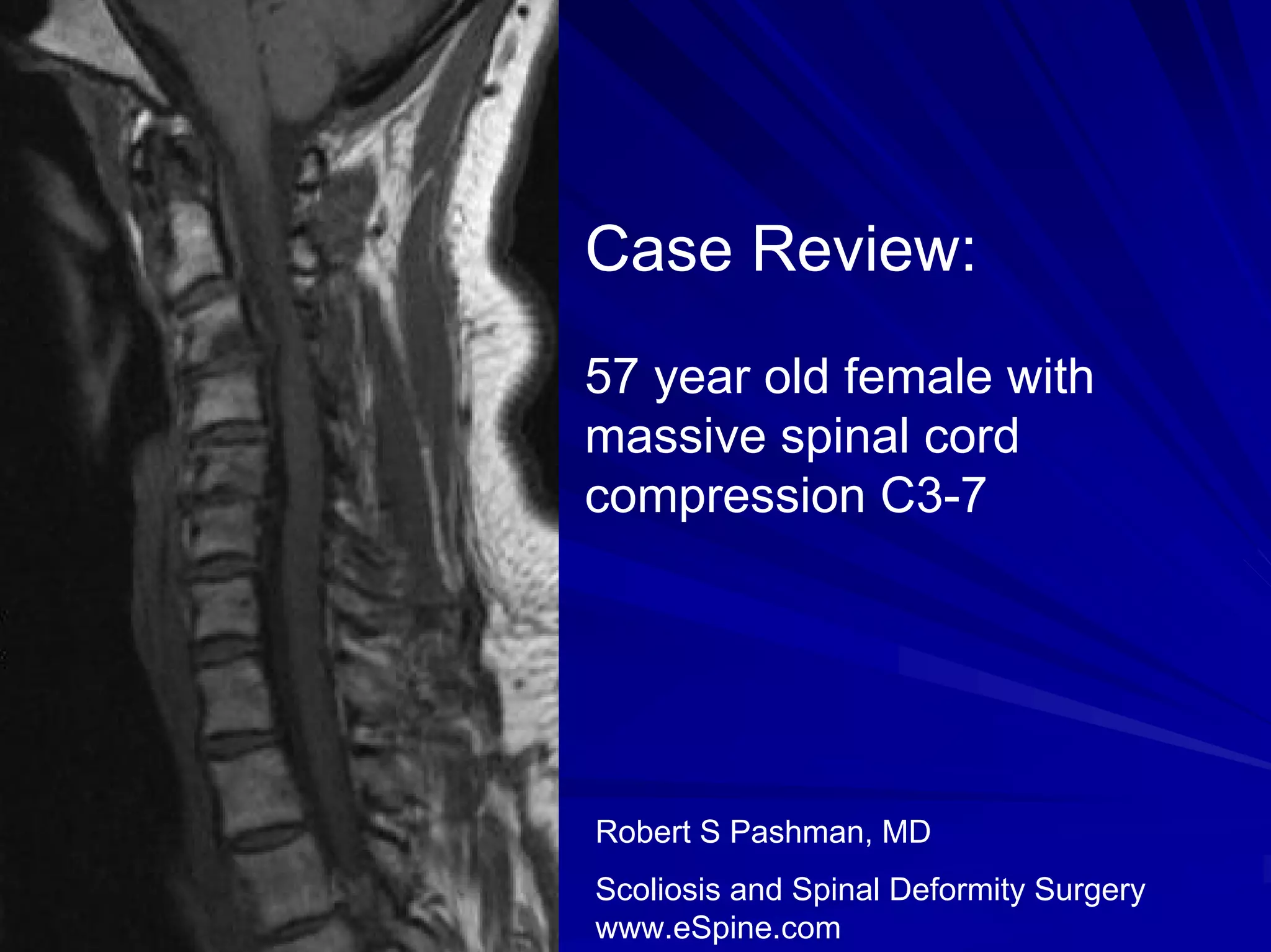 Case Review #6: 57 year old female with severe spinal cord compression ...