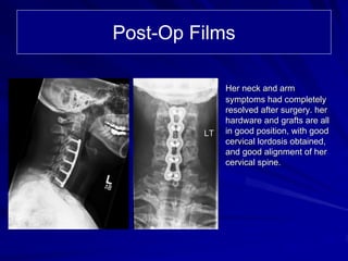 Case Review #6: 57 year old female with severe spinal cord compression ...