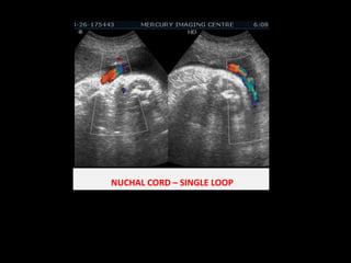 Umbilical Cord Around Neck Ultrasound