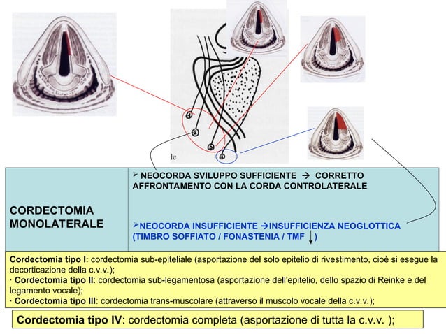 Cordectomie powerpointbellobello11111.ppt